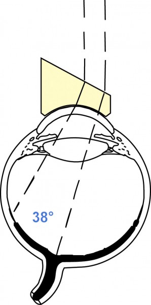 Landers HRI 30° Prism Vitrectomy Lens