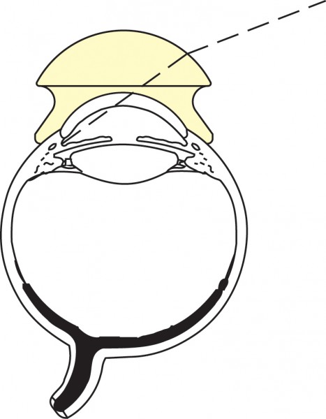 Koeppe Diagnostic Gonio Lens - Medium