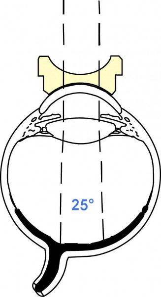 Landers Biconcave Vitrectomy Lens
