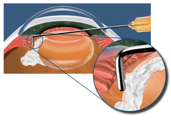 AccuDrop - Disposable Ophthalmic Cannulas & Cystotomes